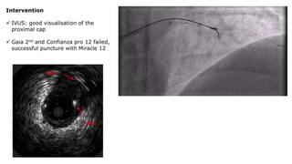 39 year old patient with mid-LAD CTO – successful IVUS-guided puncture ...