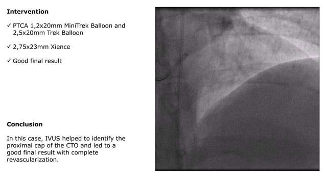 39 year old patient with mid-LAD CTO – successful IVUS-guided puncture ...