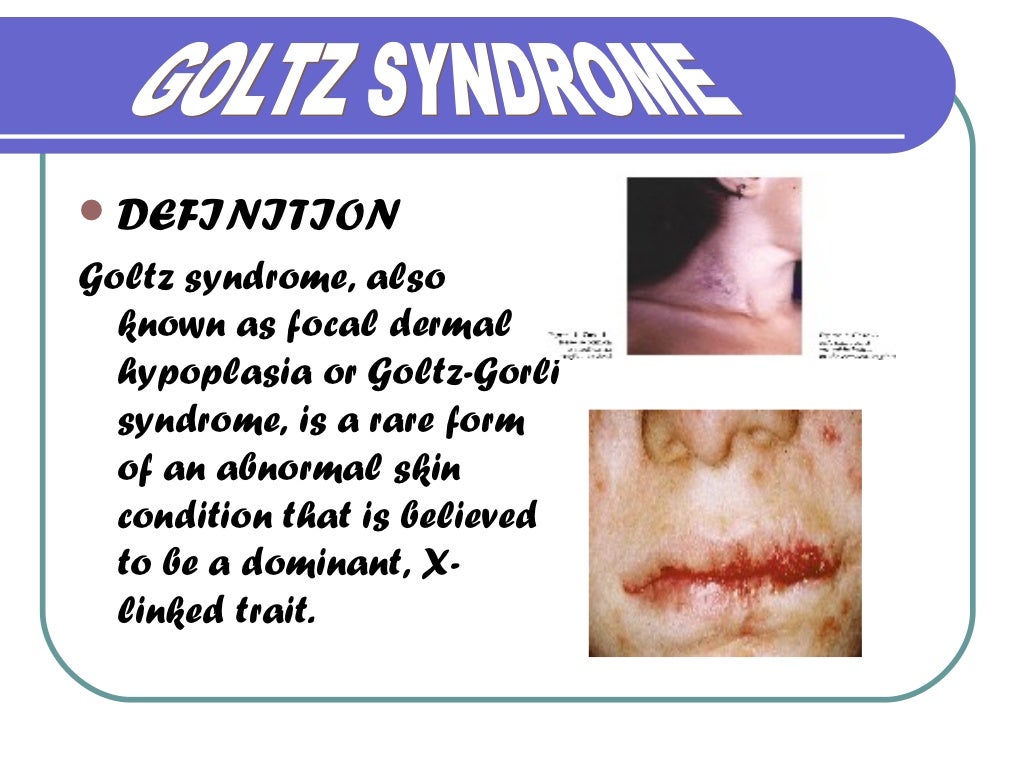craniofacial anomalies down , apert's and gorlin goltz syndrome