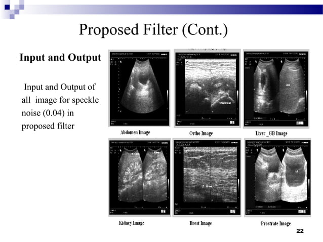 Speckle Noise Reduction in Ultrasound Images using Adaptive and Anisotropic Diffusion filter | PPT