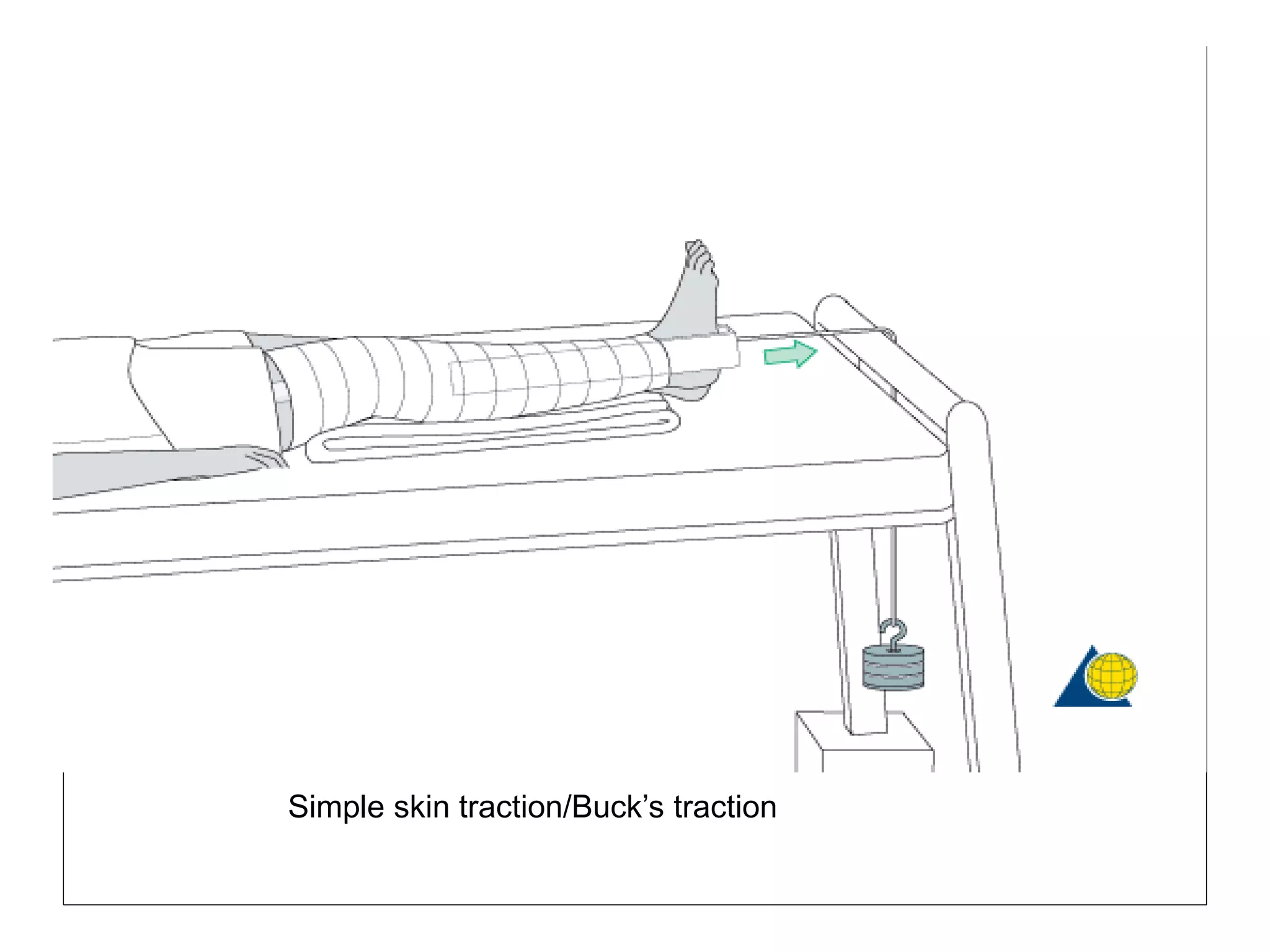 Ortho - Splinting, Traction, POP | PPT