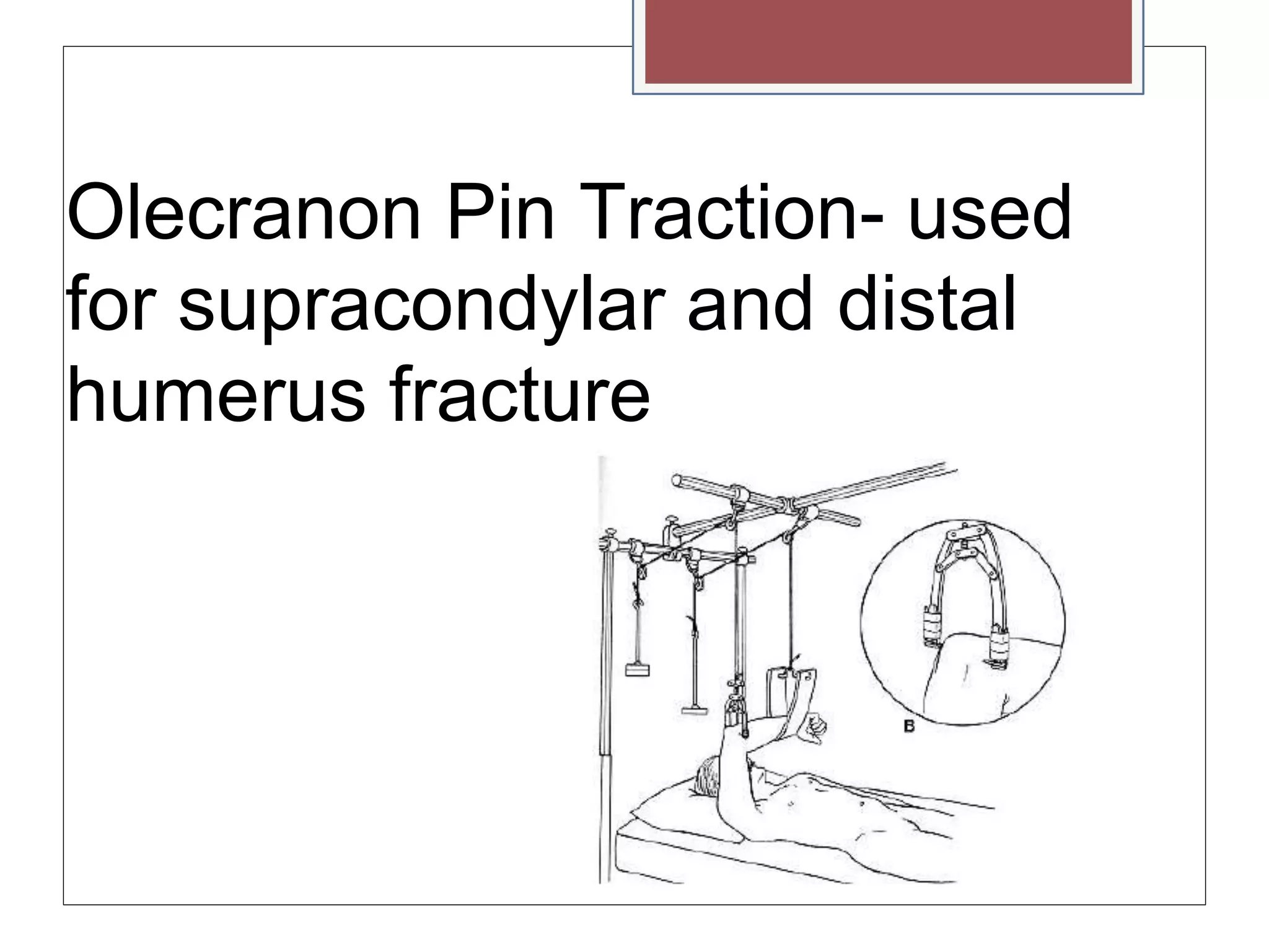 Ortho - Splinting, Traction, POP | PPT