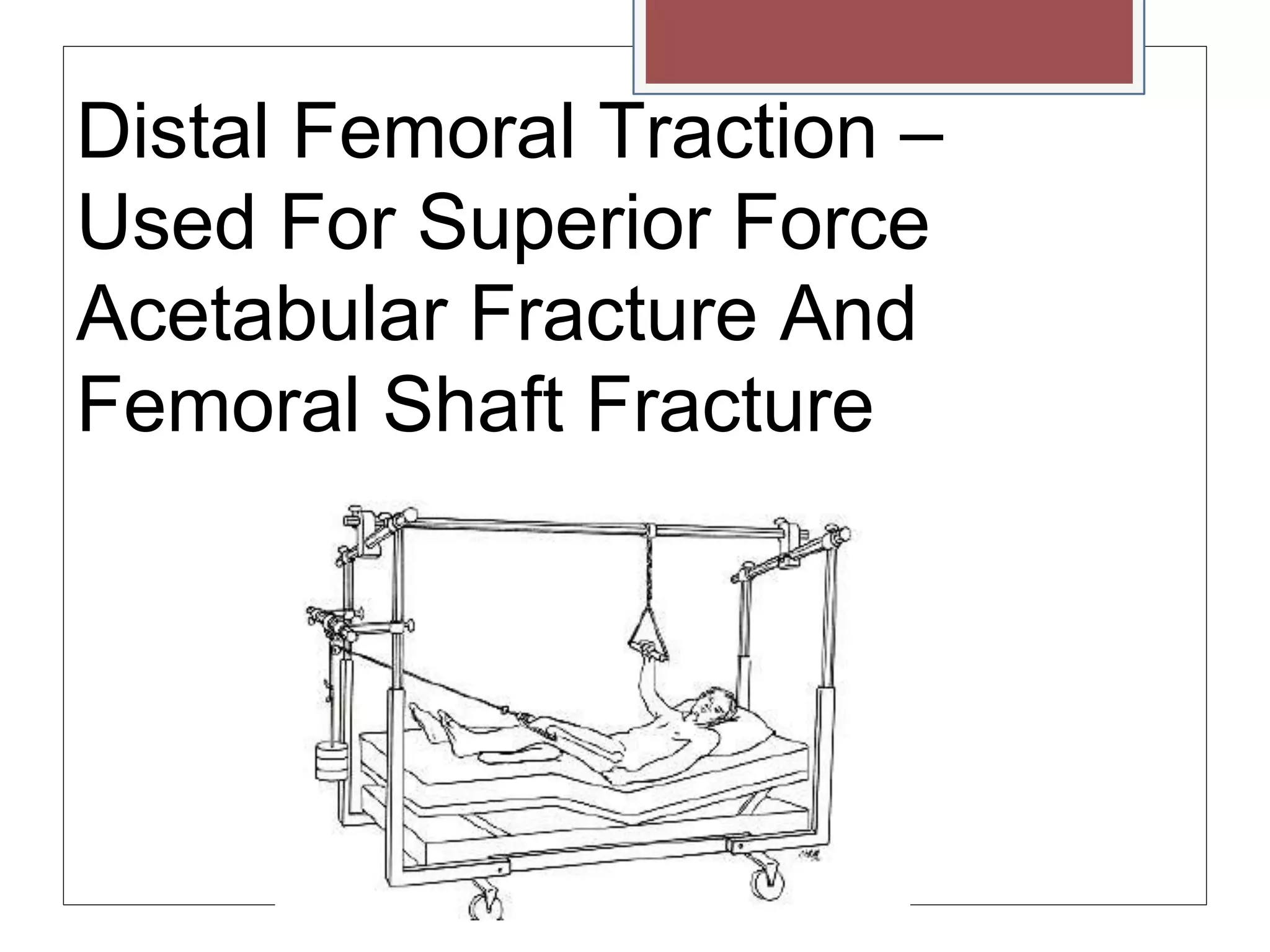 Ortho - Splinting, Traction, POP | PPT