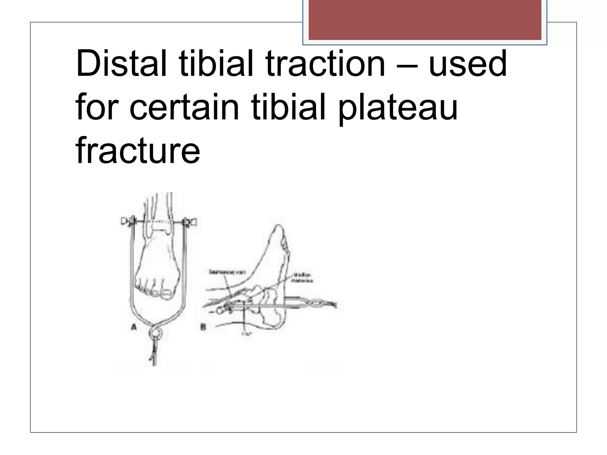 Ortho - Splinting, Traction, POP | PPT