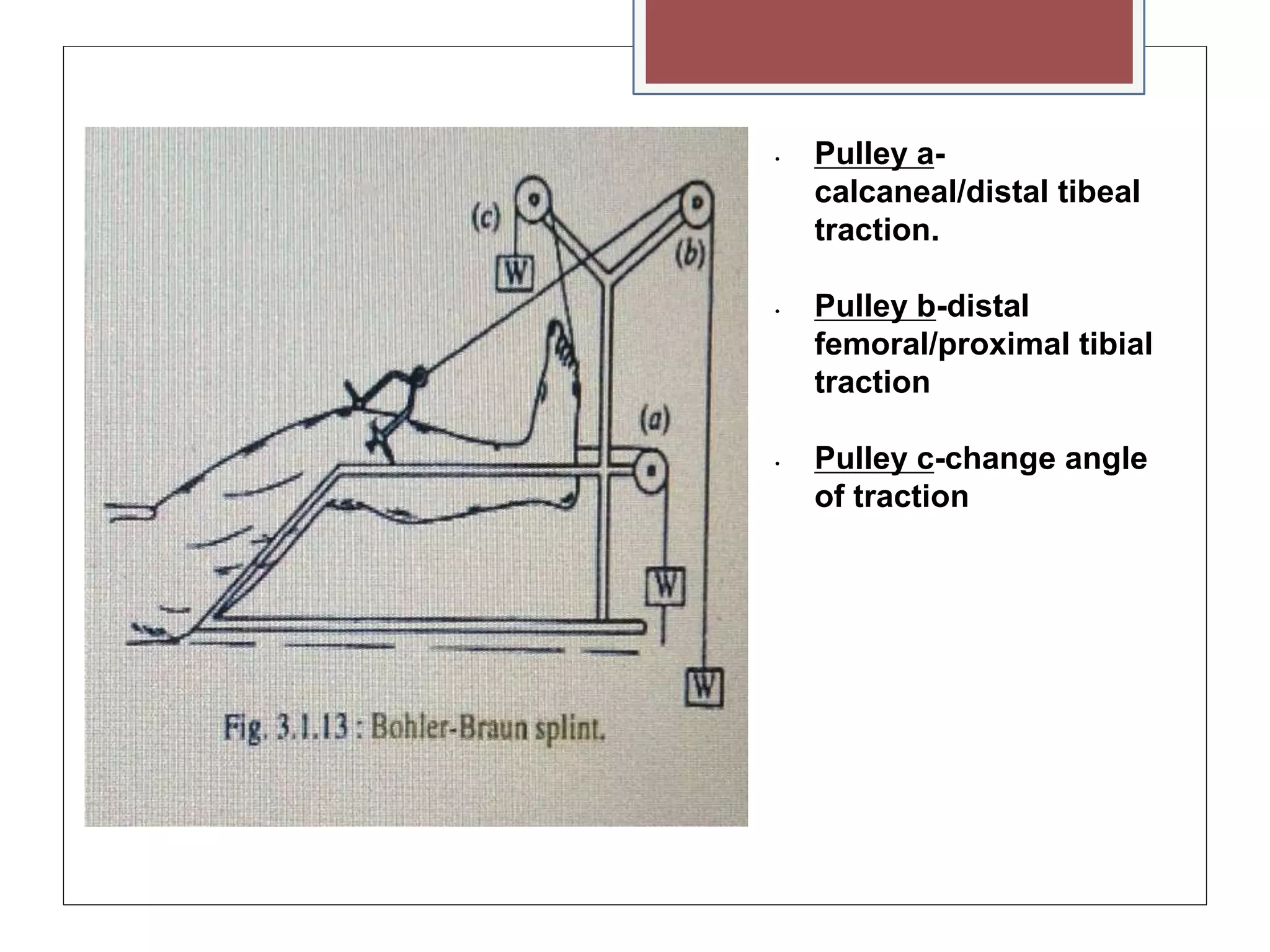 Ortho - Splinting, Traction, POP | PPT