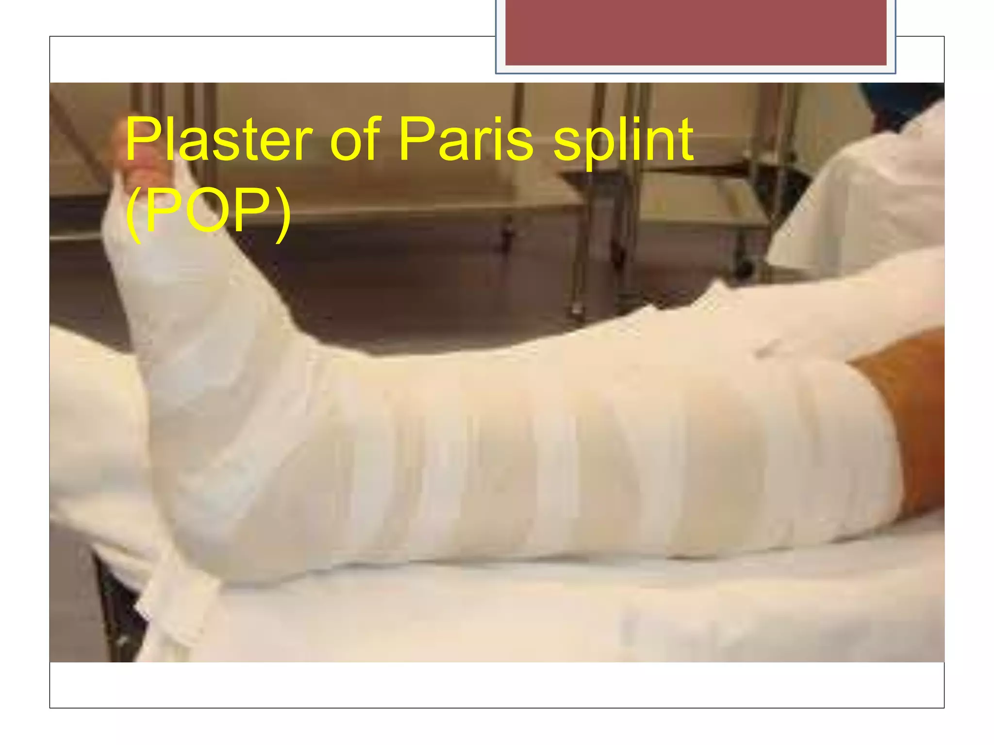 Ortho - Splinting, Traction, POP | PPT