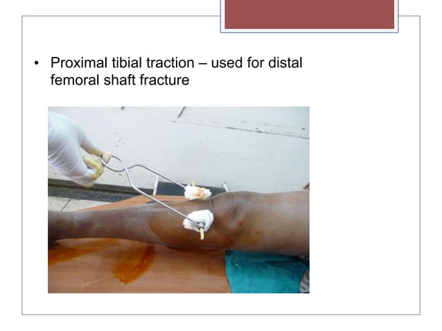 Ortho - Splinting, Traction, POP | PPT