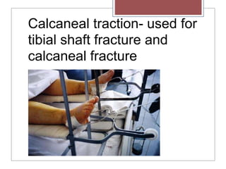 Ortho - Splinting, Traction, POP | PPT