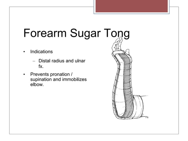 Ortho - Splinting, Traction, POP | PPT