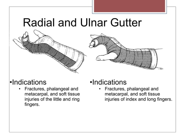 Ortho - Splinting, Traction, POP | PPT