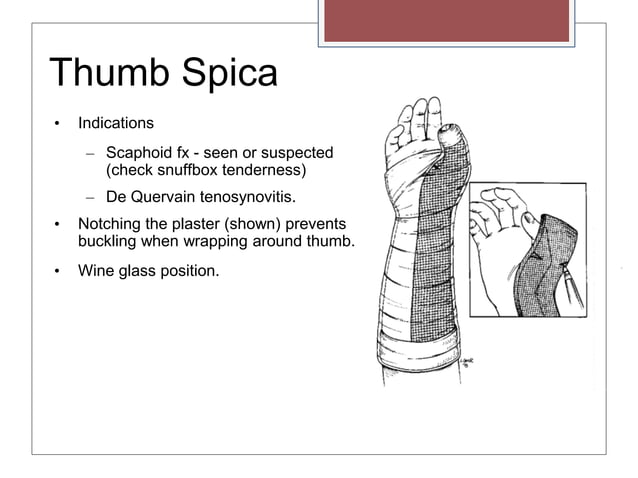Ortho - Splinting, Traction, POP | PPT