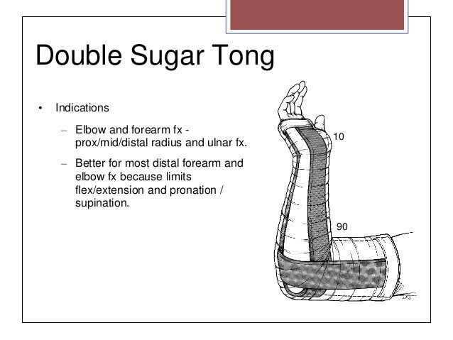 Sugar Tong Double Medical Splinting Ulnar Broward Workshop General ...
