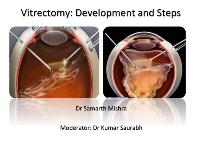 Vitrectomy: Development And Steps | PPTX | Eye and Vision Conditions ...