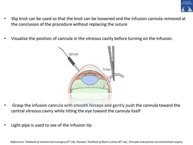 Vitrectomy: Development And Steps | PPTX | Eye and Vision Conditions ...