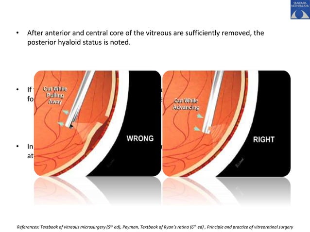 Vitrectomy: Development And Steps | PPTX | Eye and Vision Conditions ...