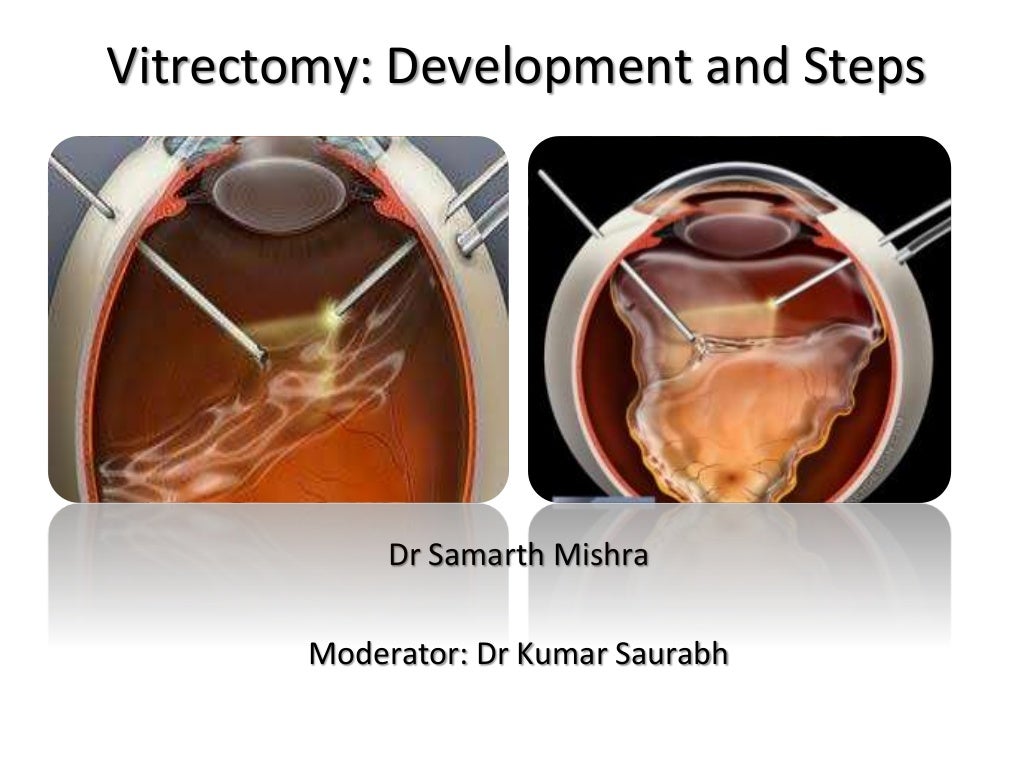 Vitrectomy: Development And Steps