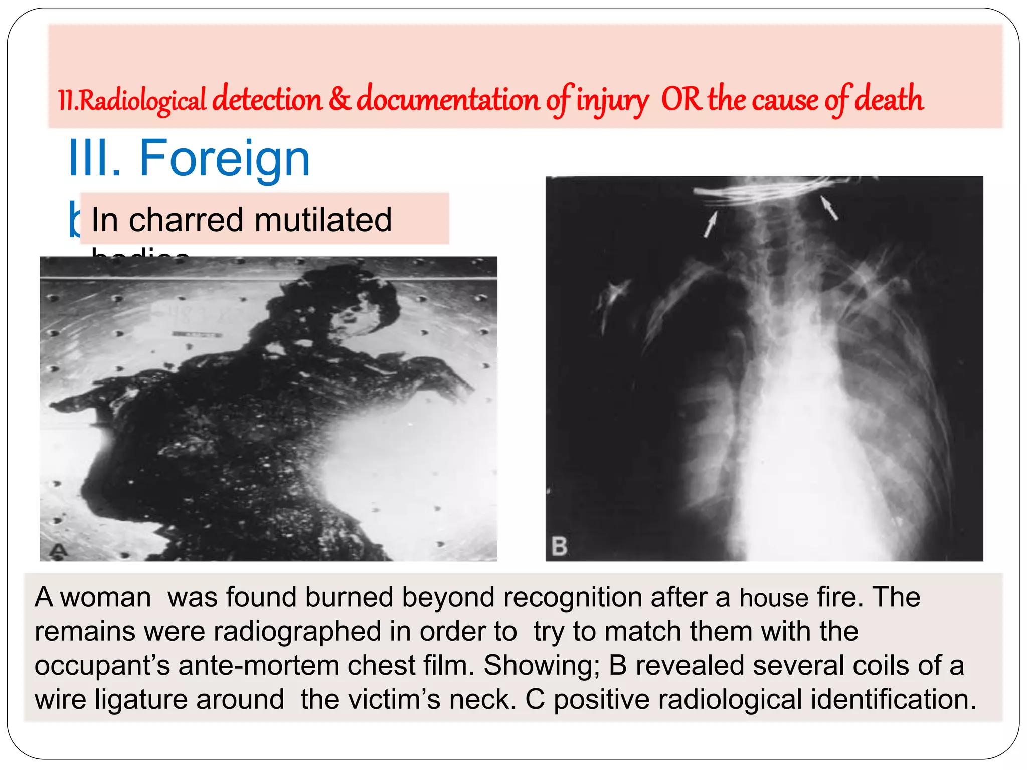 Presentation forensic radiology | PPTX