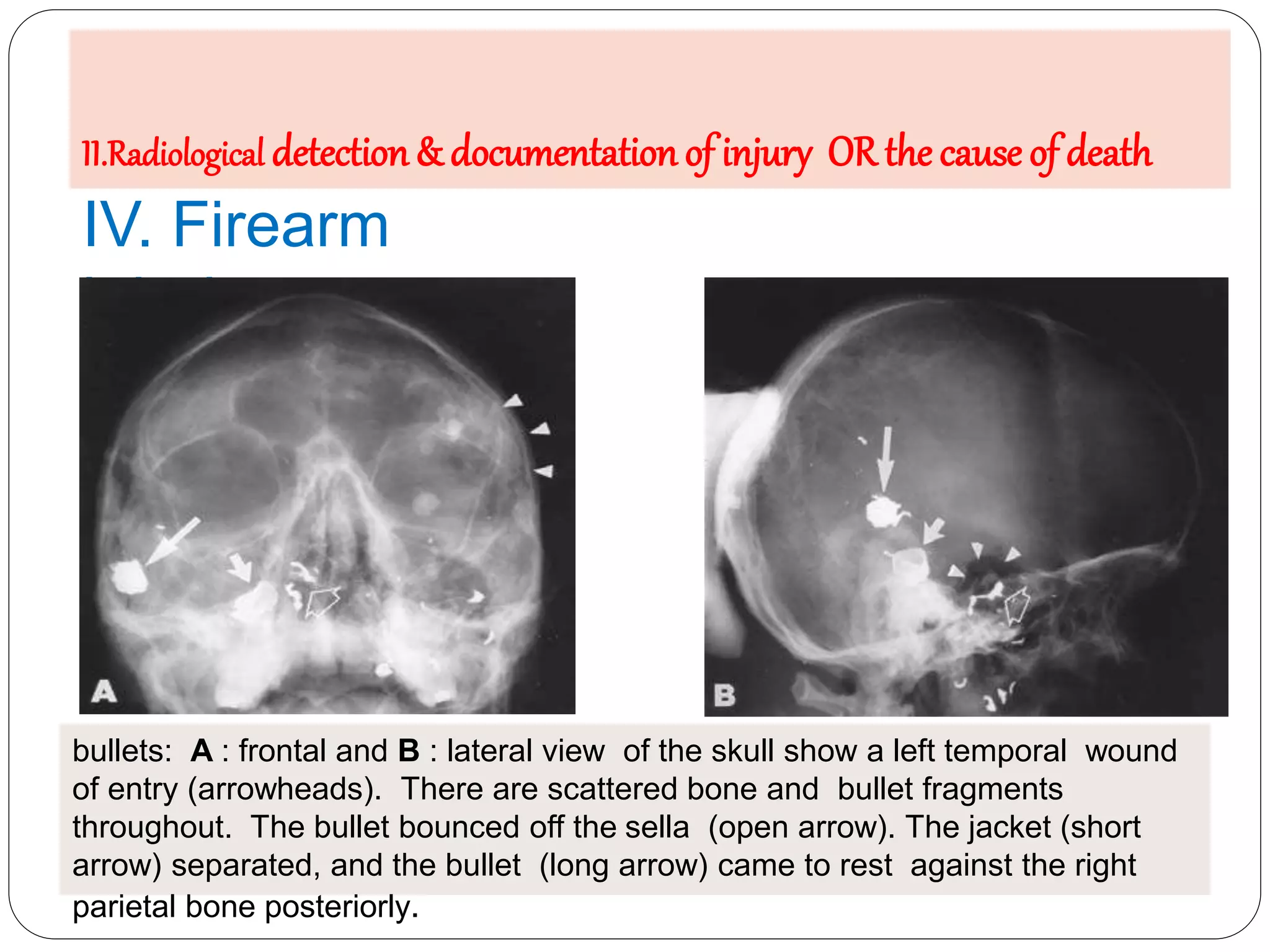Presentation forensic radiology | PPTX