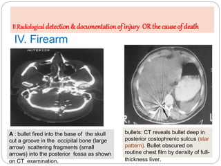 Presentation forensic radiology | PPTX