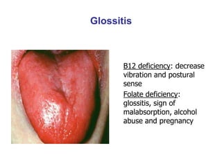 Glossitis B12