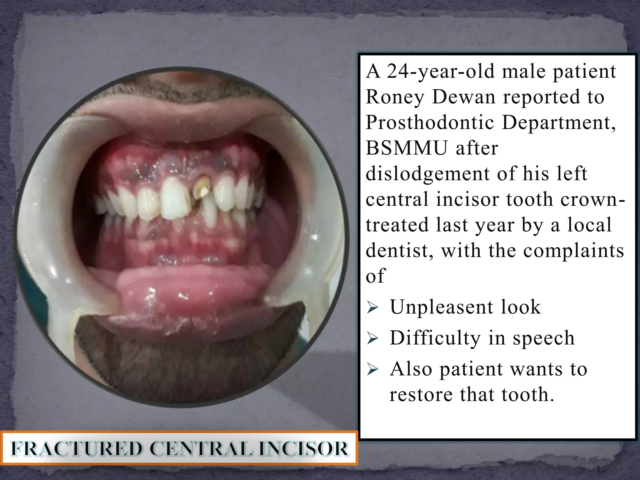 A CASE OF FRACTURED UPPER CENTRAL INCISOR TOOTH RESTORED BY FIBER ...