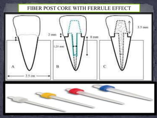 A CASE OF FRACTURED UPPER CENTRAL INCISOR TOOTH RESTORED BY FIBER ...