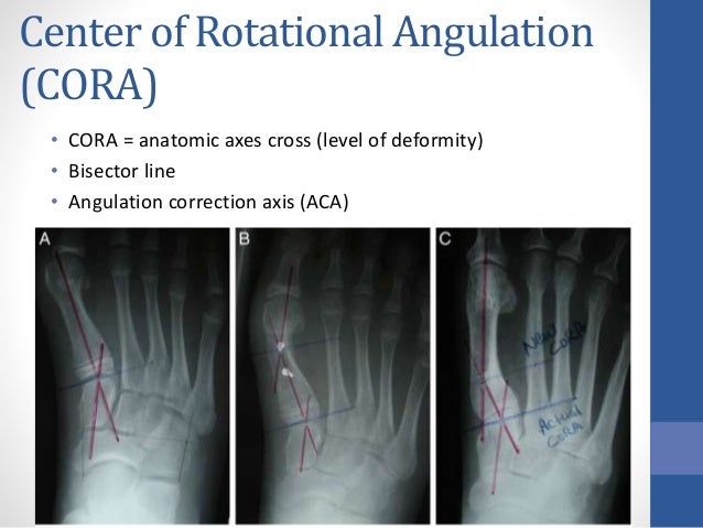 Presentation frontal plane correction in hav surgery
