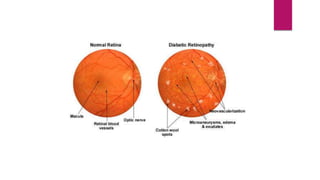 Fundoscopy, DM-retinopathy and HTN- retinopathy ppt | PPTX