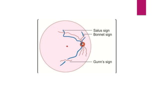 Fundoscopy, DM-retinopathy and HTN- retinopathy ppt | PPTX