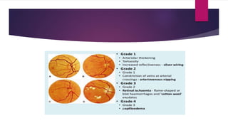 Fundoscopy, DM-retinopathy and HTN- retinopathy ppt | PPTX