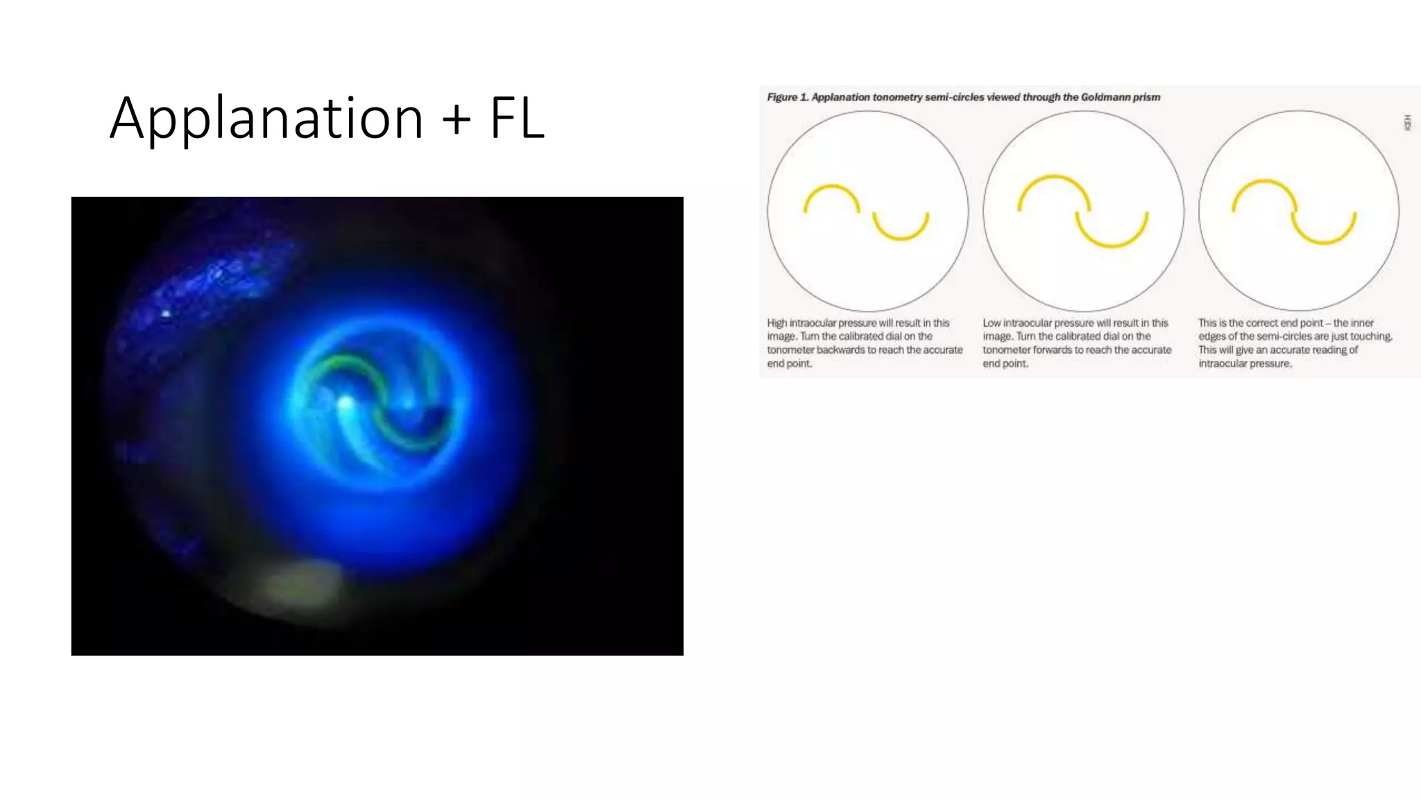 Gradual Visual loss.pptx