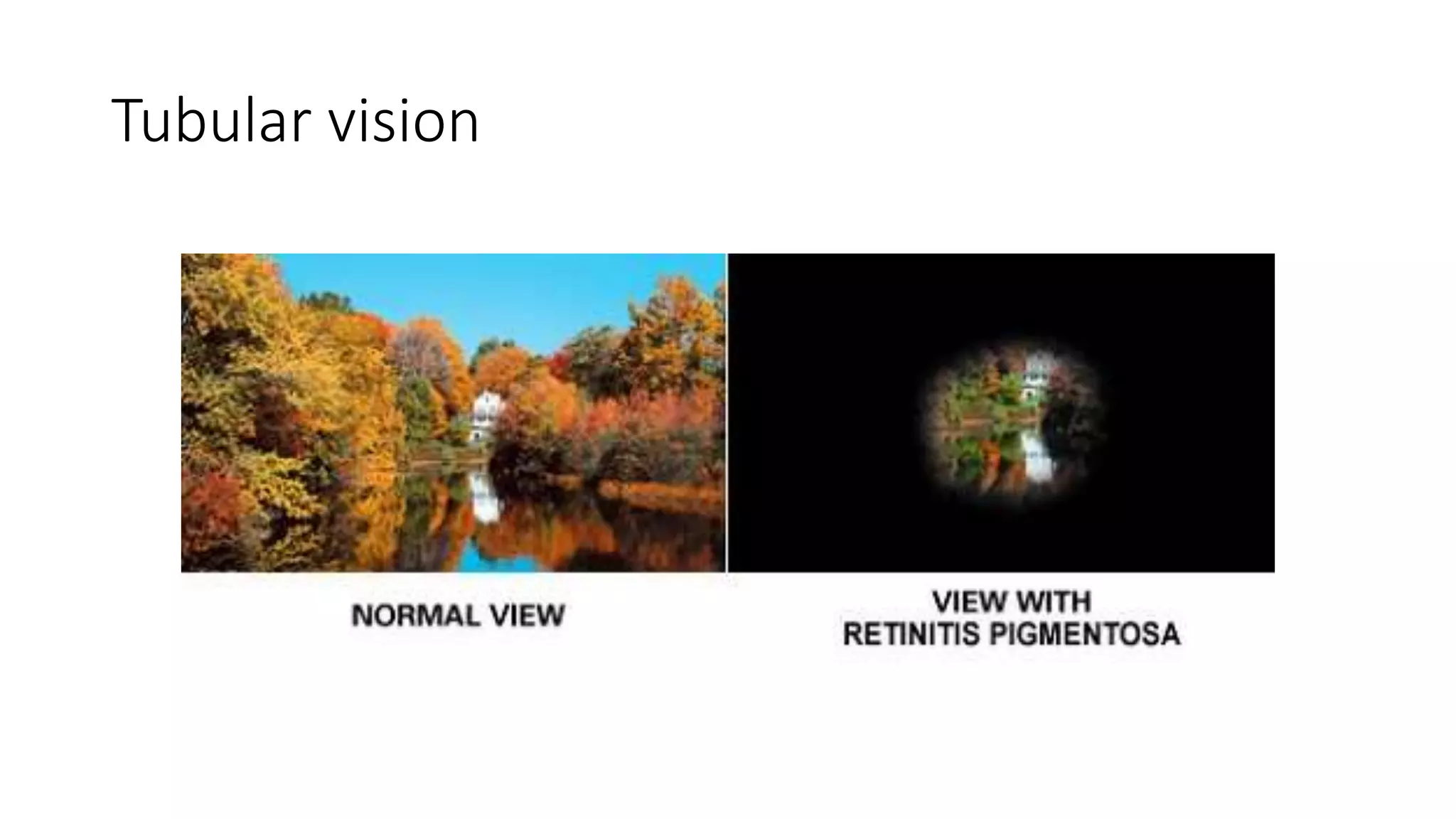 Gradual Visual loss.pptx