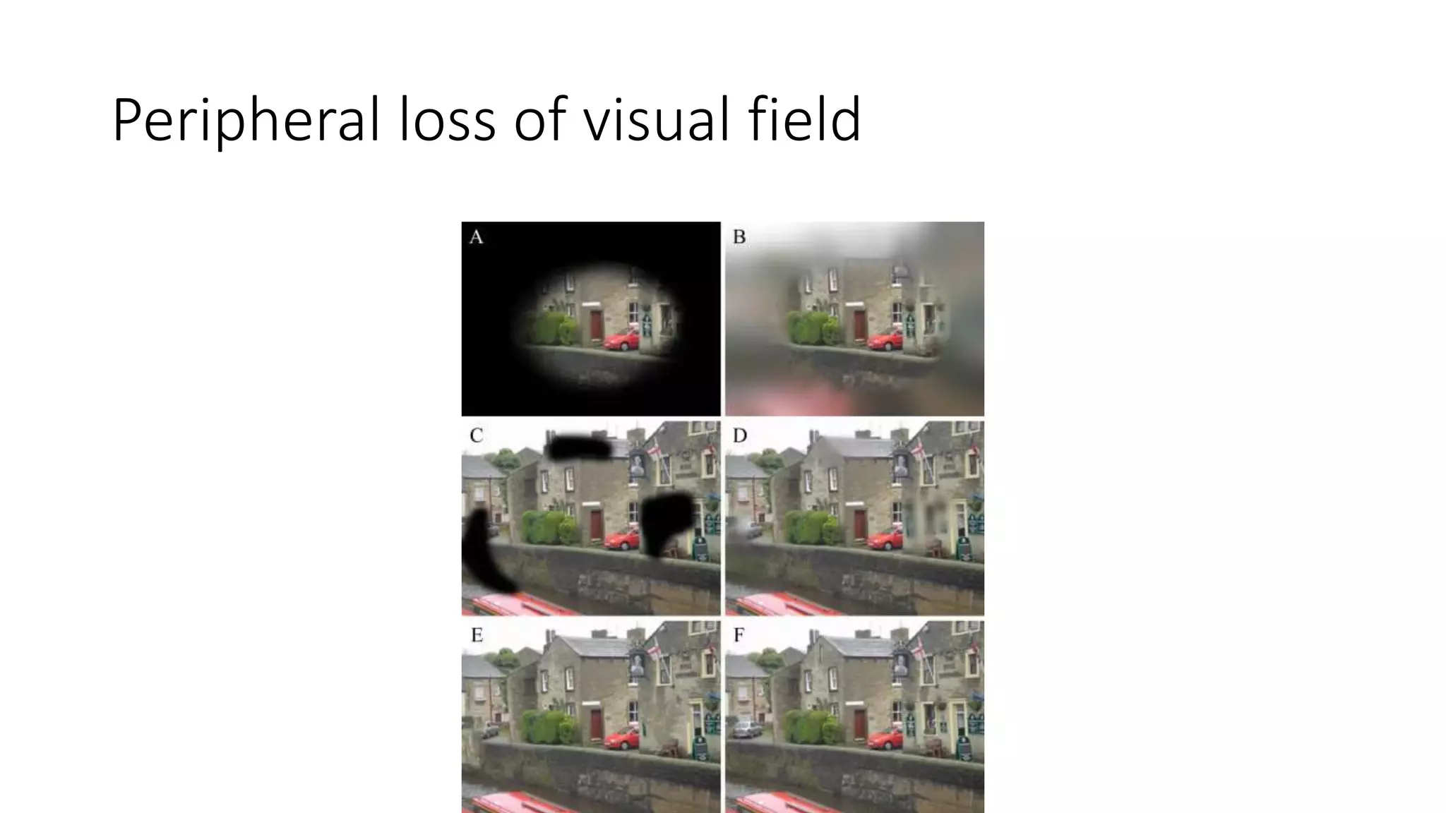 Gradual Visual loss.pptx