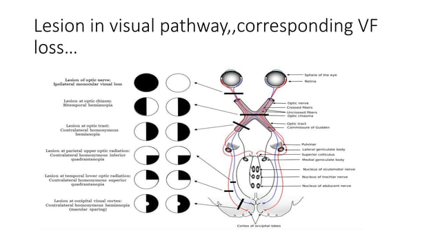 Gradual Visual loss.pptx