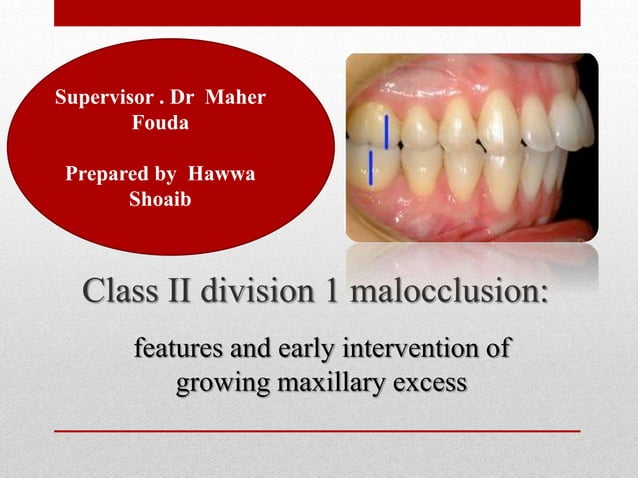 Class II division 1 malocclusion | PPT