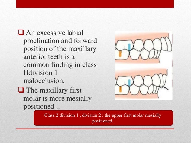 Class II division 1 malocclusion