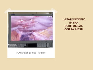 HERNIA PRESENTATION Presentation HERNIA.pptx