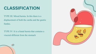 Presentación Hiatal Hernia y sus características | PDF