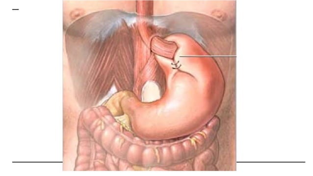 Presentación Hiatal Hernia y sus características | PDF