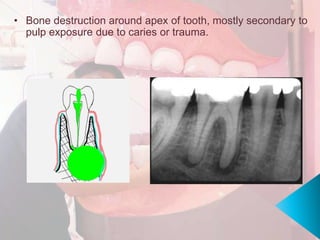 pulpoperiapical lesion | PPTX