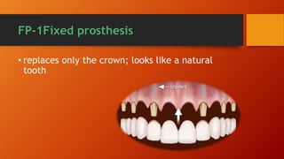 Dental implant prosthesis | PPTX