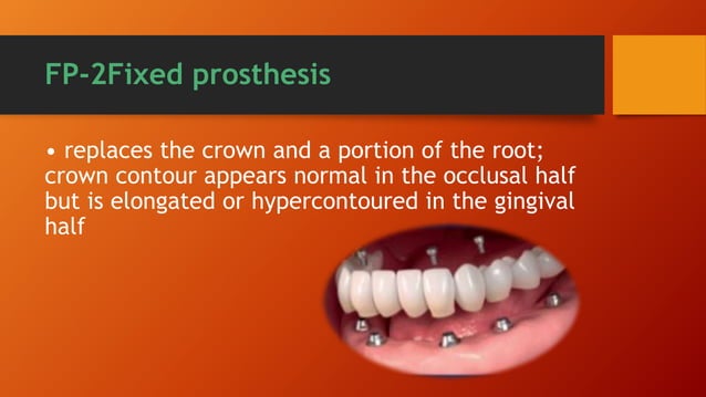 Dental implant prosthesis | PPTX