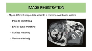 Intensity Modulated Radiotherapy (IMRT) - Dr. S. Sachin | PPTX