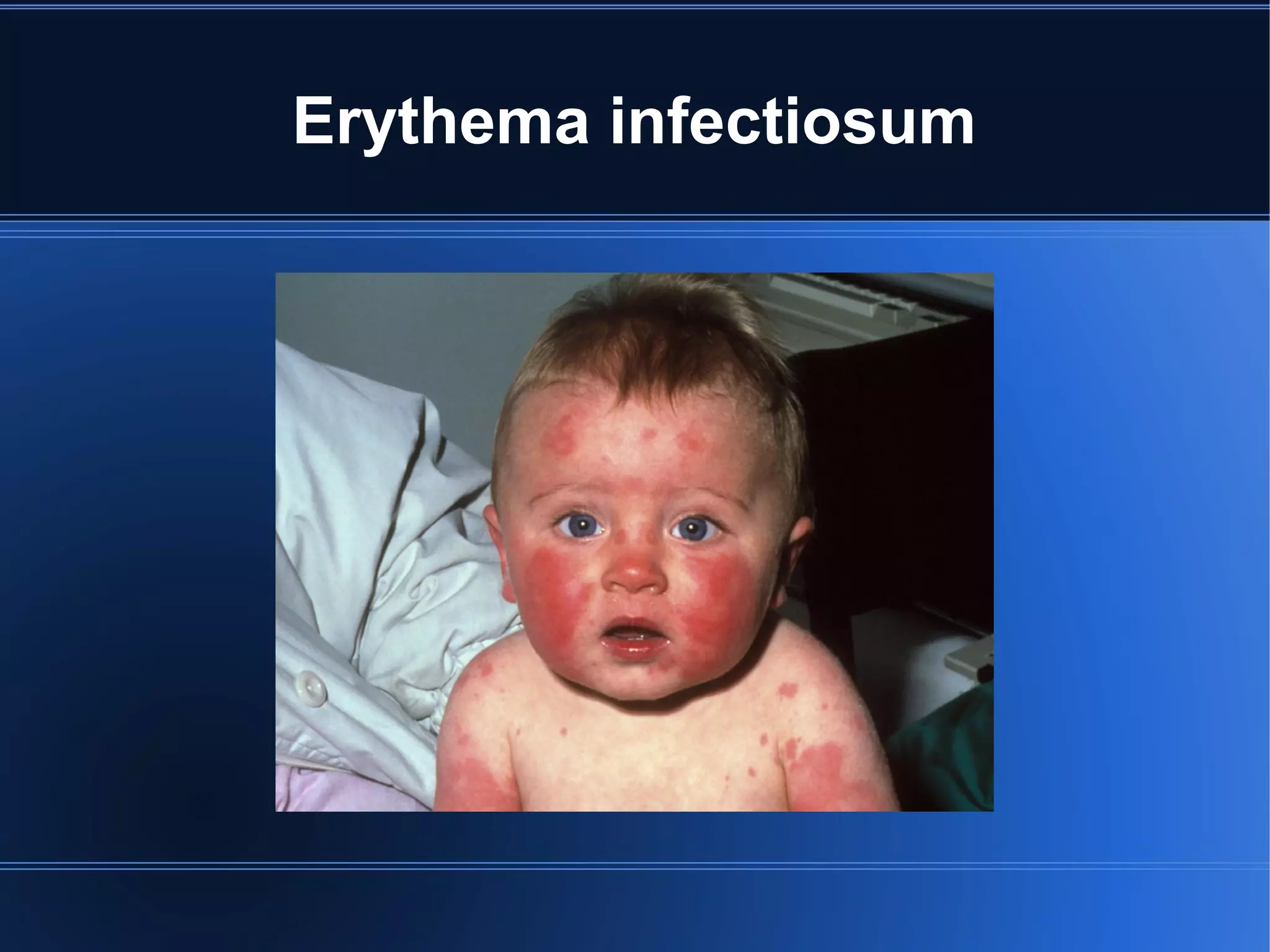 Rash differential Diagnosis of Infectious diseases | PPT