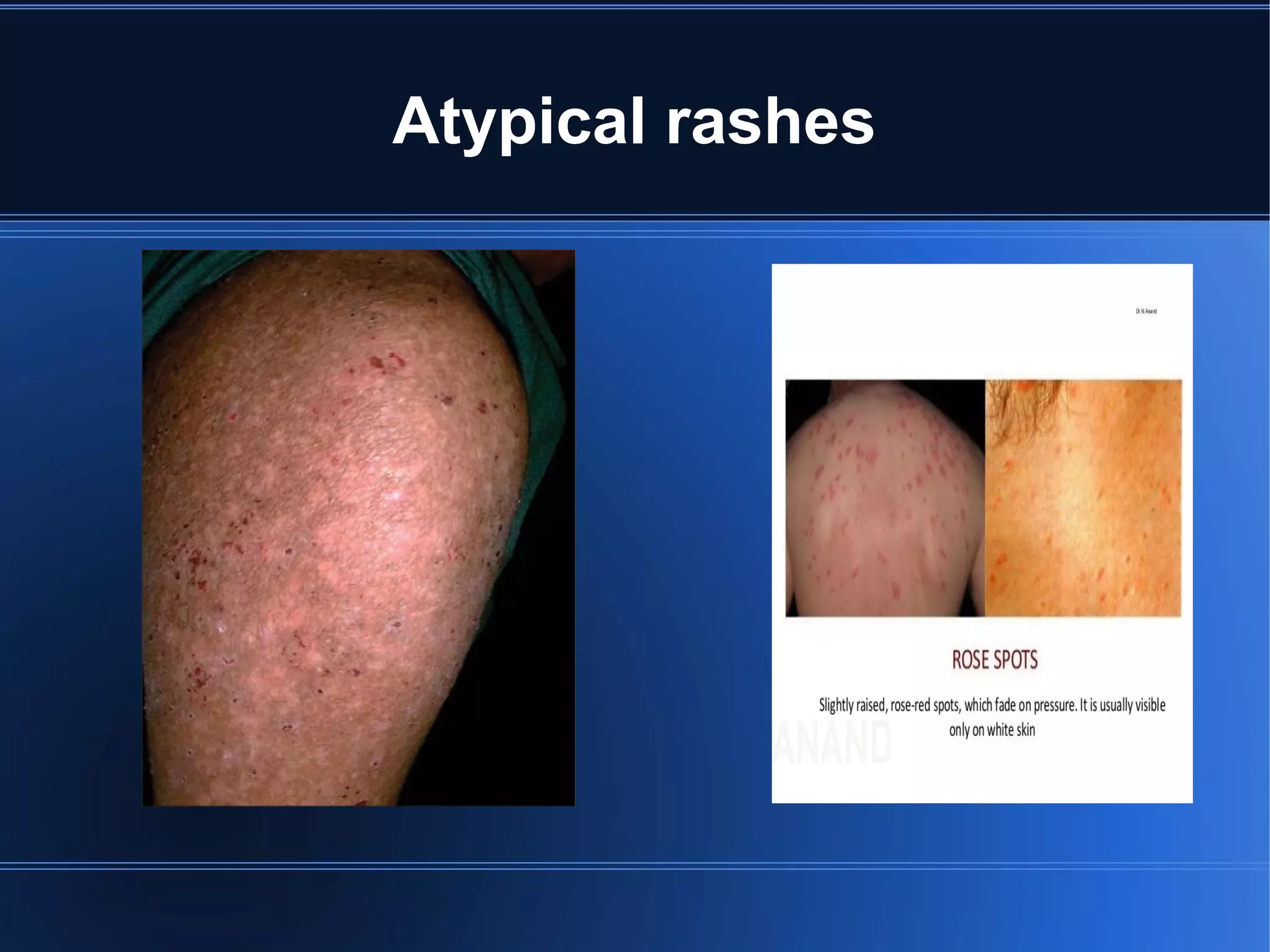 Rash differential Diagnosis of Infectious diseases | PPT