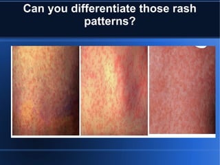 Rash differential Diagnosis of Infectious diseases | PPT