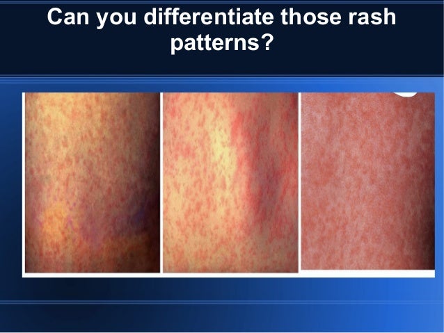 Rash differential Diagnosis of Infectious diseases