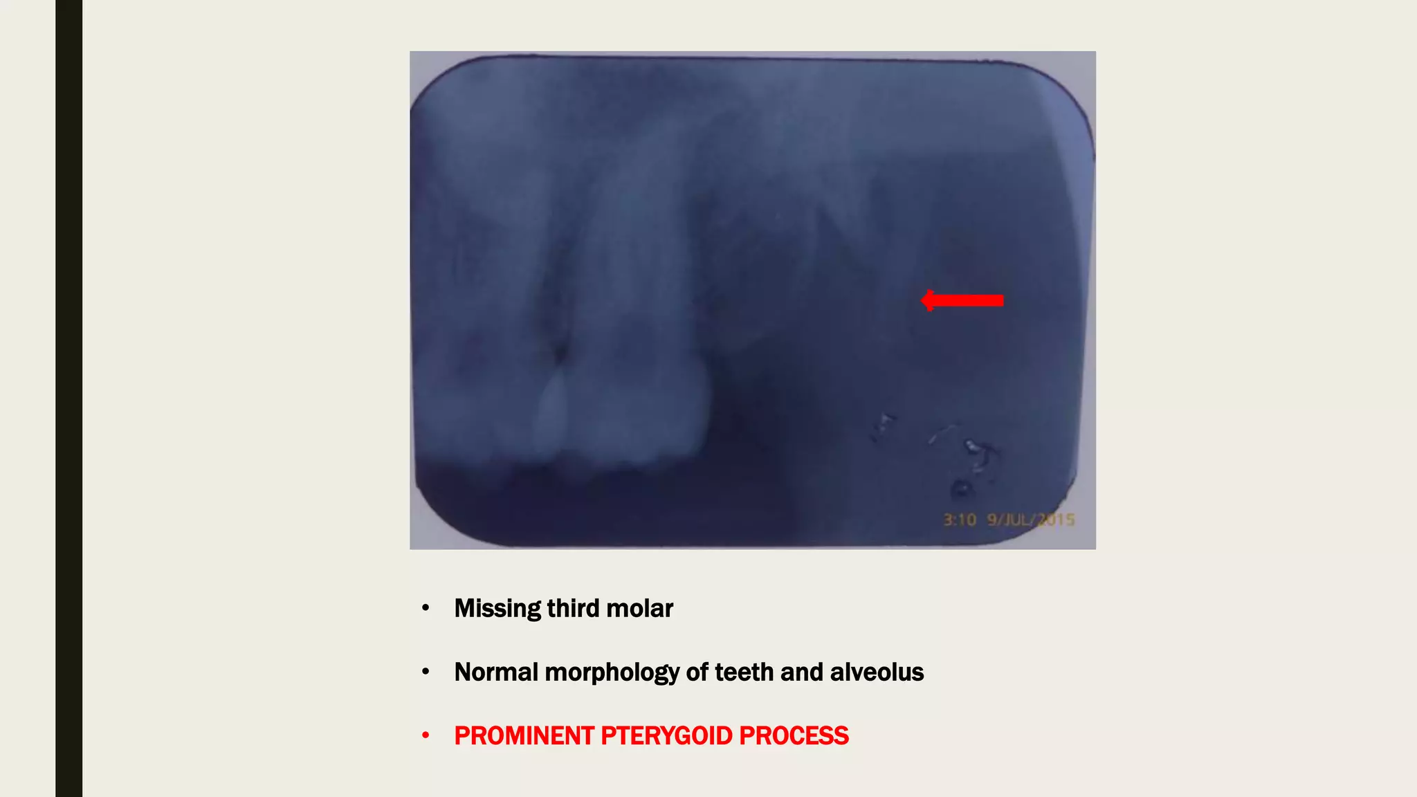 PTERYGOID HAMULUS SYNDROME- A CASE REPORT | PPT