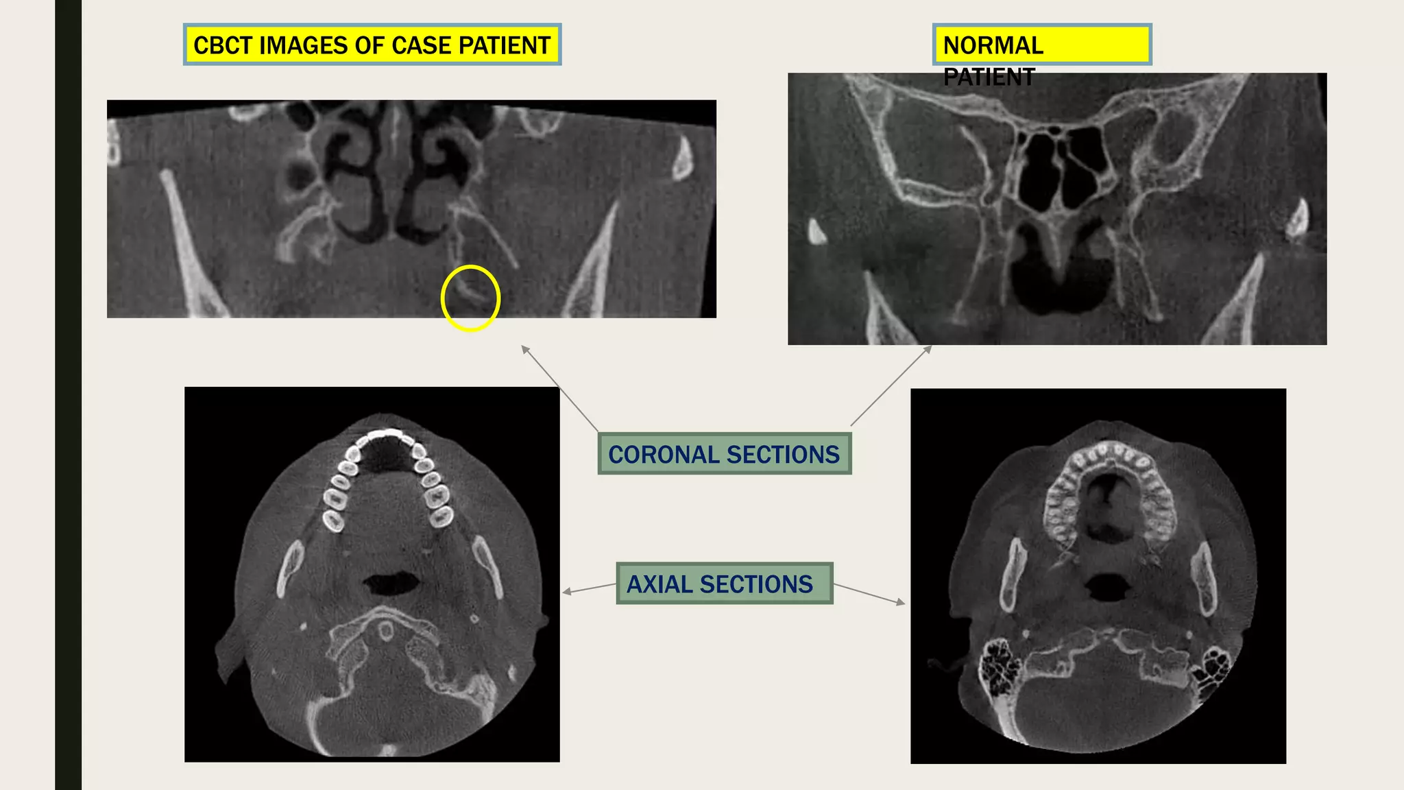 PTERYGOID HAMULUS SYNDROME- A CASE REPORT | PPT
