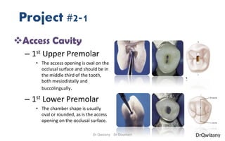 Maxillary First Premolar Canals